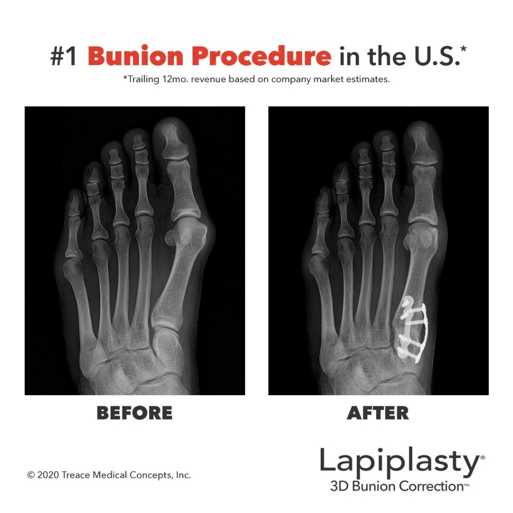Lapiplasty – Shoal Creek Foot & Ankle Center